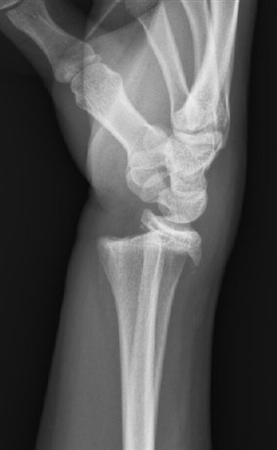 Endochondral Bone Formation - Basic Science - Orthobullets